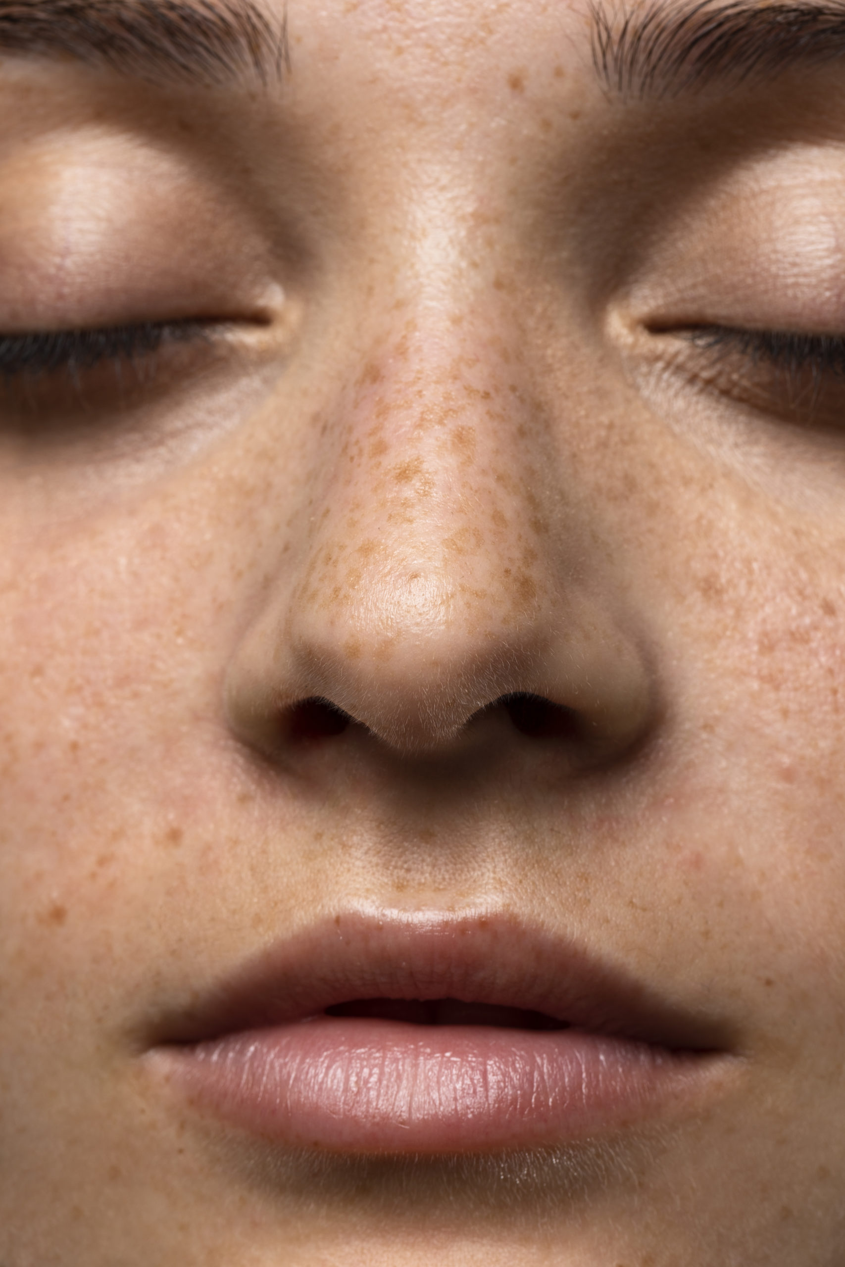 O que fazer com as manchas de sol na pele pós-verão? - SBD-RS